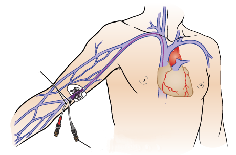 L'accès veineux, PICC Line - CH DOUAI